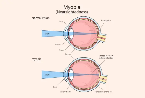 Myopia - Venkatesh Netralaya