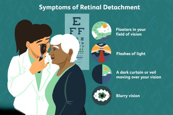 Retinal Detachment - Venkatesh Netralaya