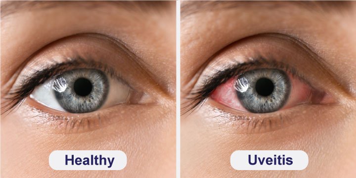 Uveitis Eye - Venkatesh Netralaya